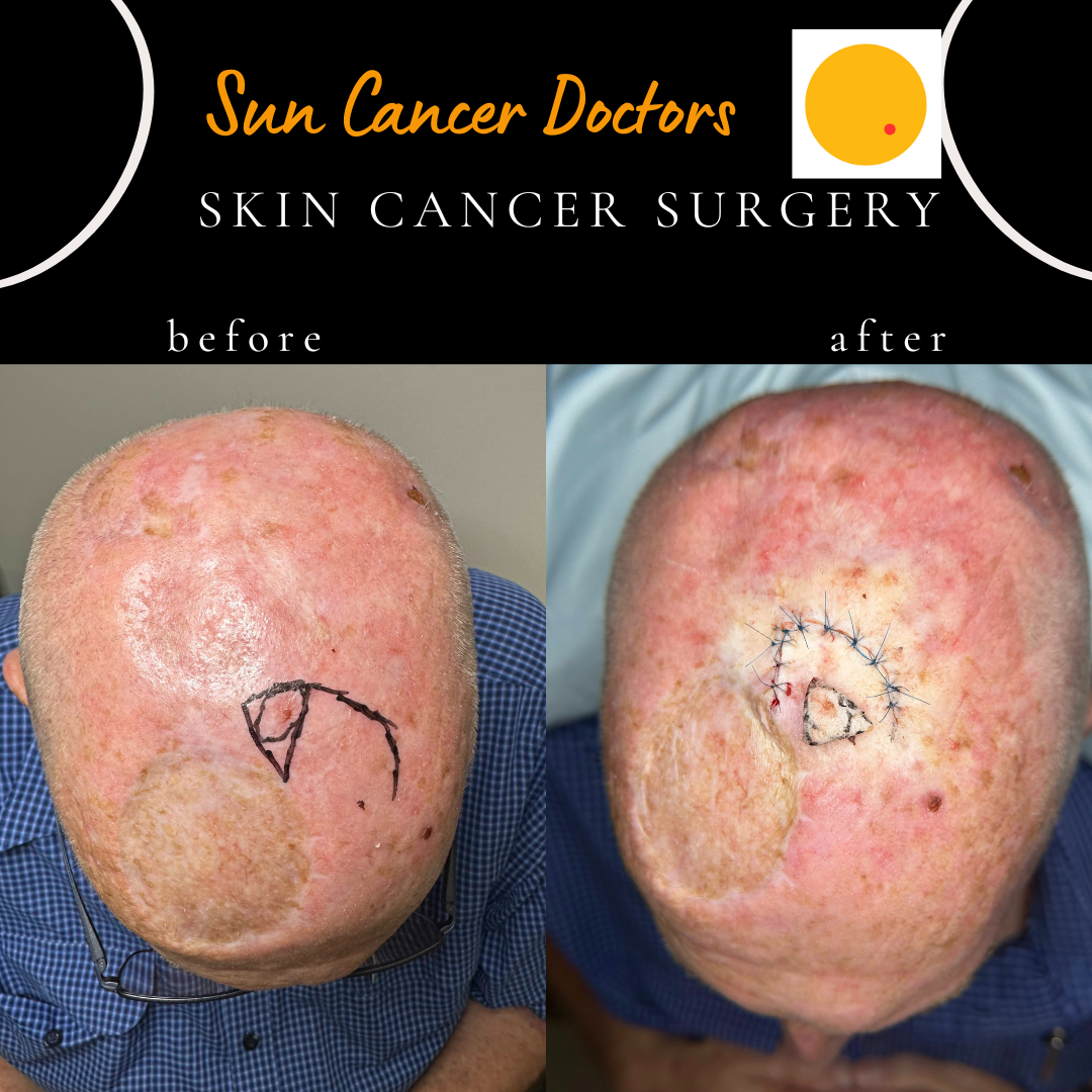 Skin Cancer Surgery - Sun Cancer Doctors - Skin Cancer Clinic ...