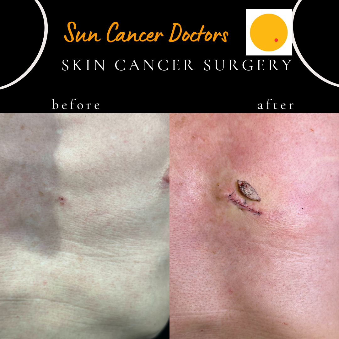 Skin Cancer Surgery - Sun Cancer Doctors - Skin Cancer Clinic ...
