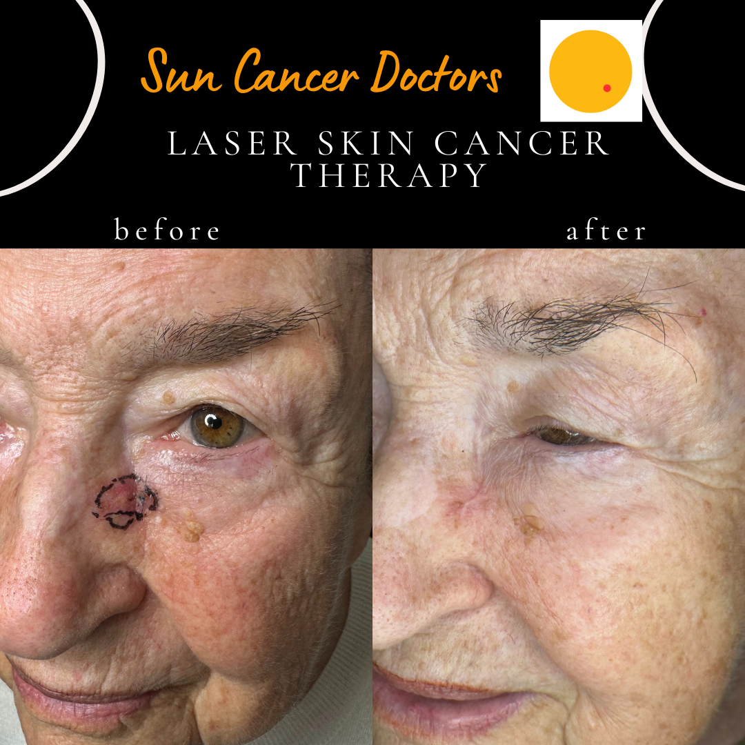 Non Surgical Skin Cancer Treatment - Sun Cancer Doctors - Skin Cancer ...